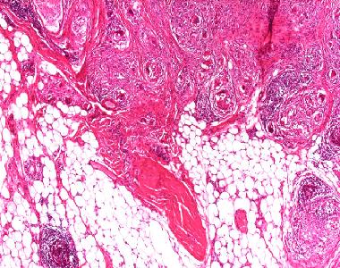 Granulom Fremdkörper , Dermis – NDTTFV
